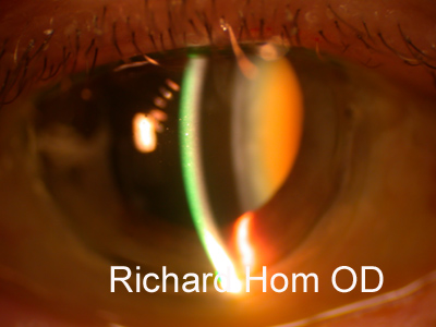 Photo Atlas, Page 2 - Richard Hom OD FAAO