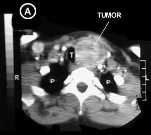 Bocio del Tiroides Intratoracico