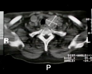 Bocio del Tiroides Intratoracico - Caso 2