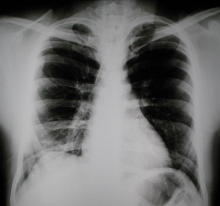 Estenosis de traquea