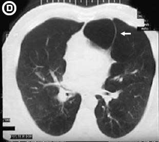 Esternotomia y reseccion bulas pulmonares bilaterales
