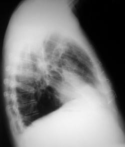 Esternotomia y reseccion bulas pulmonares bilaterales