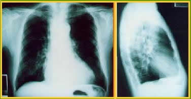 Tumor Carcinoide del Timo