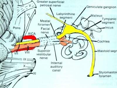 PERİFERİK FASİAL PARALİZİ