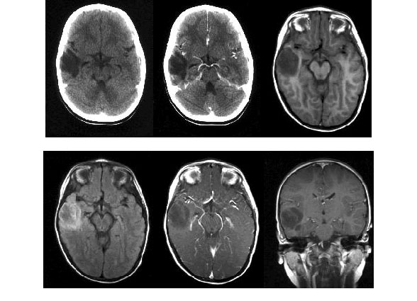 Dysembryoplastic Neuroepithelial Tumor (DNET)