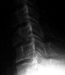 Hyperflexion teardrop fracture