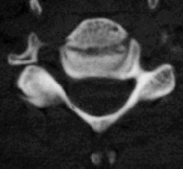 Hyperflexion teardrop fracture