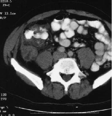 Appendiceal Diverticulitis