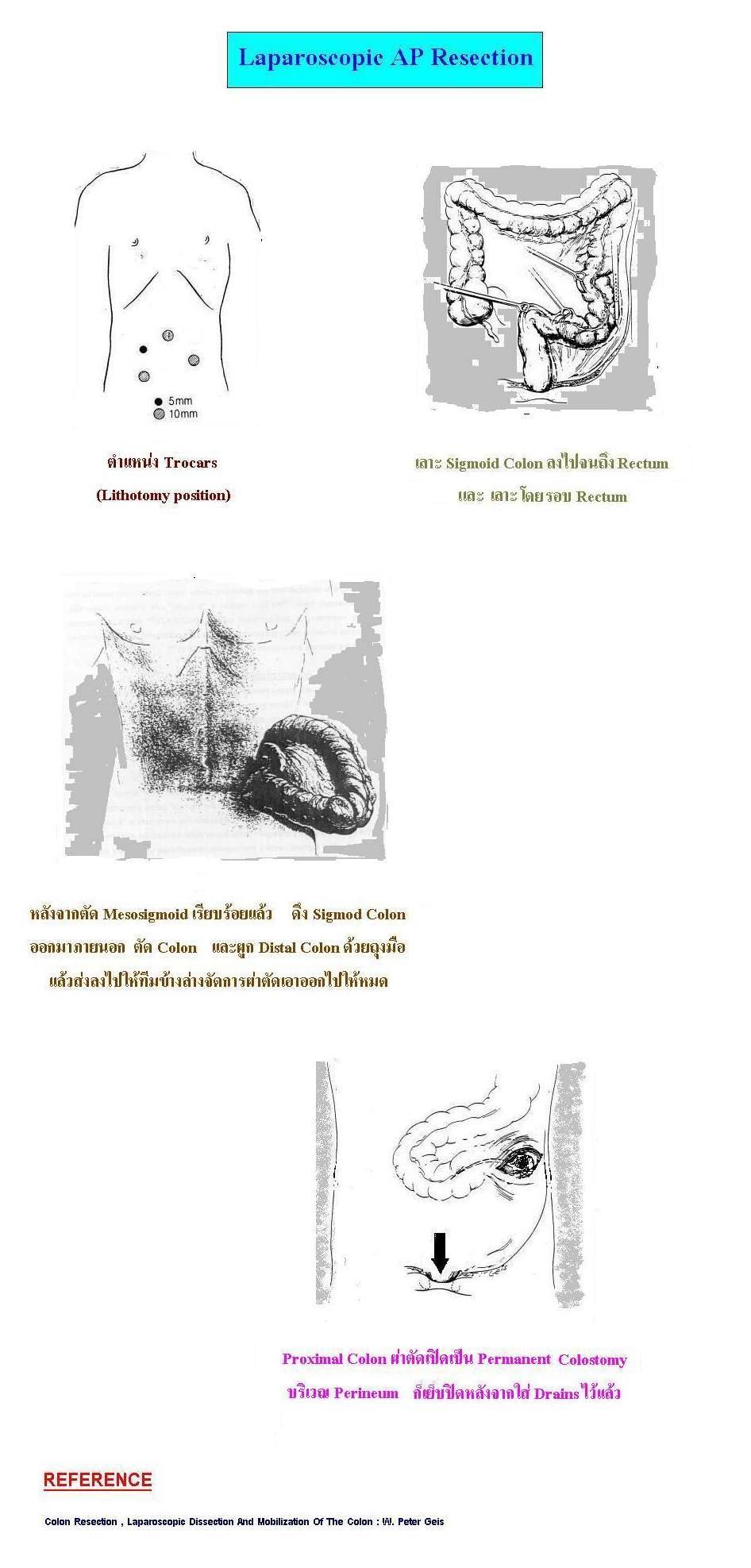Laparoscopic Colectomy