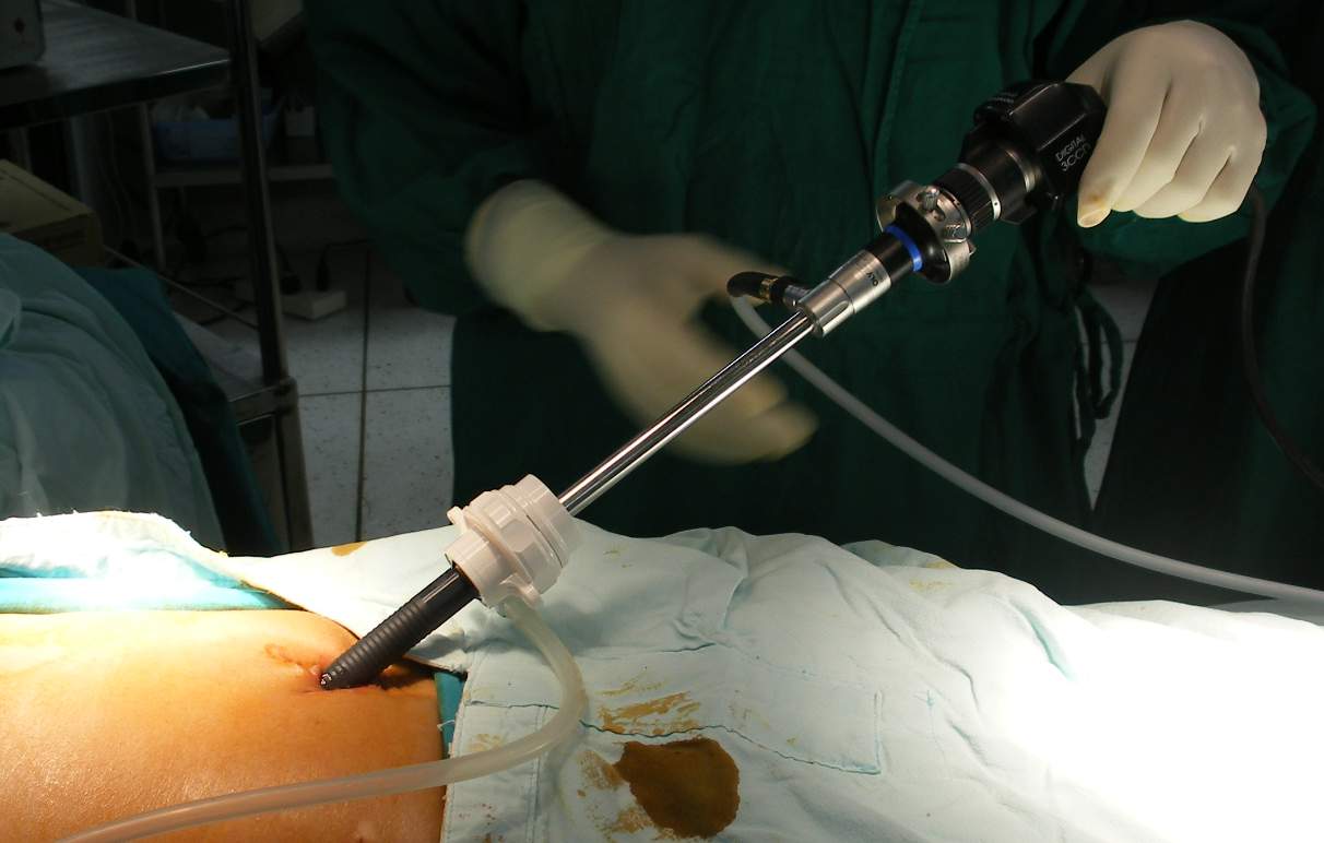 laparoscopic surgery